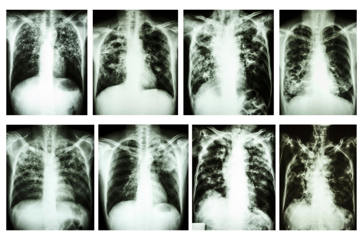 World film premiere: watch cell infected with tuberculosis die